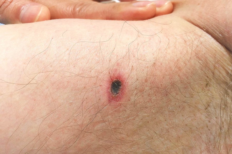 Over 3,500 infected with scrub typhus in Nepal since mid-July - Asia ...